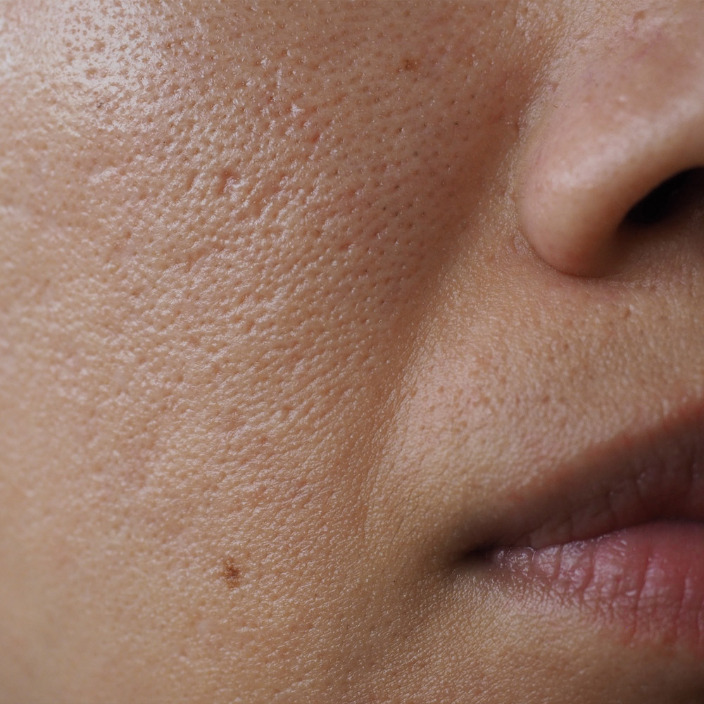 Enlarged Pores | High Performance Skincare | Rodial